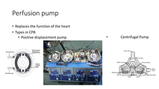 Cardiopulmonary bypass: Basic circuit, anticoagulation, blood ...