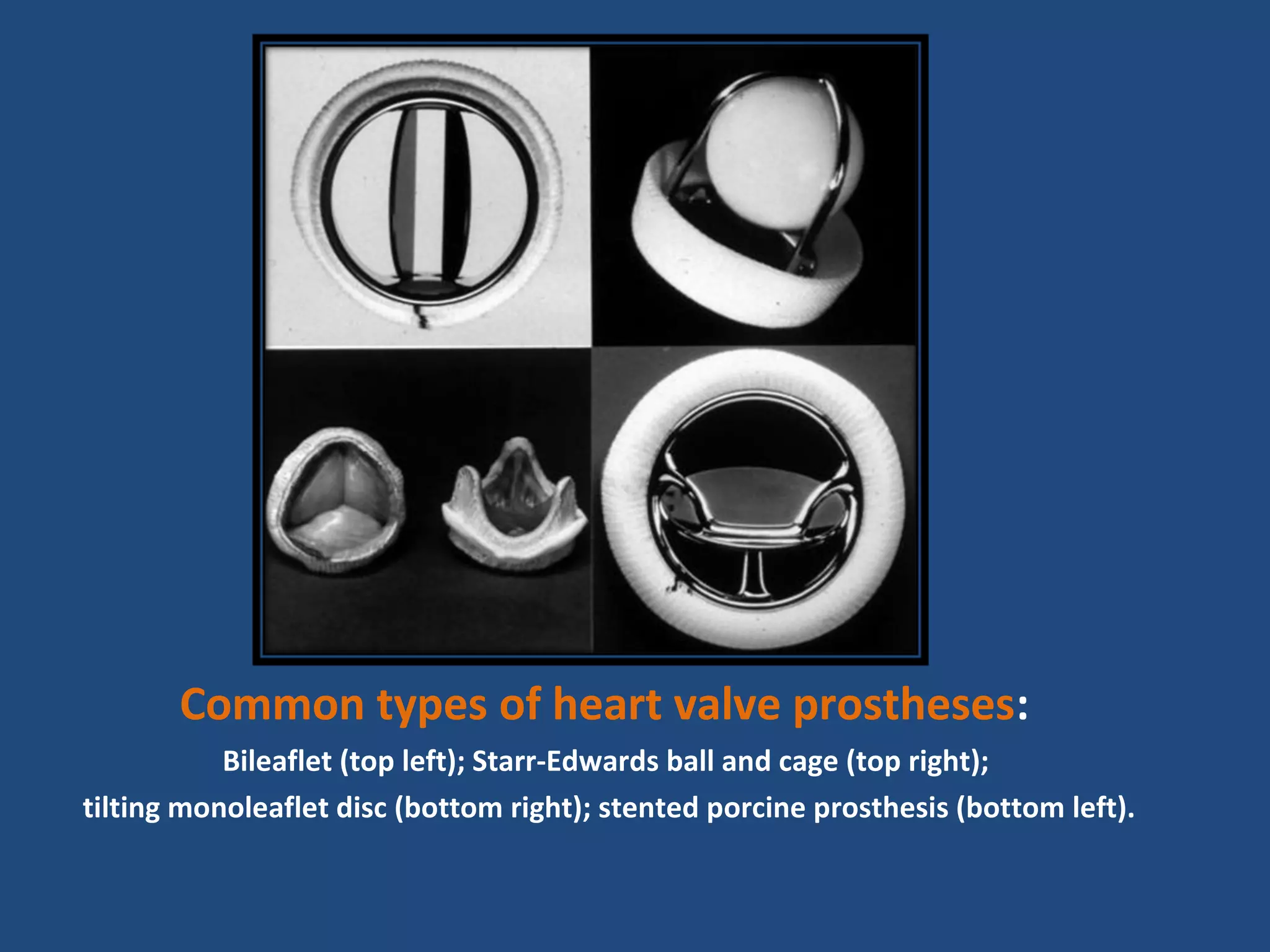 Cardiopulmonary Bypass and Valvular Surgery | PPT