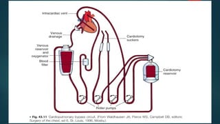 Cardiopulmonary Bypass (CPB) | Heart-Lung Machine, Procedure, Risks ...