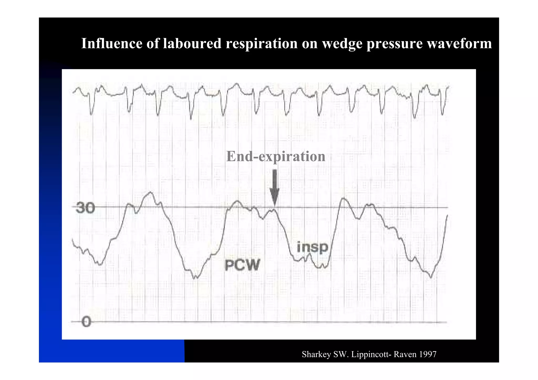 Cardio Pulmonary Interactions during Mechanical Ventilation | PDF
