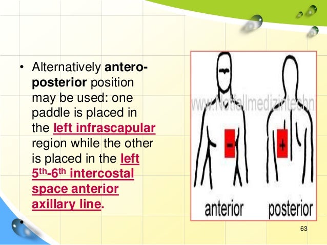 Anteroposterior Aed Placement