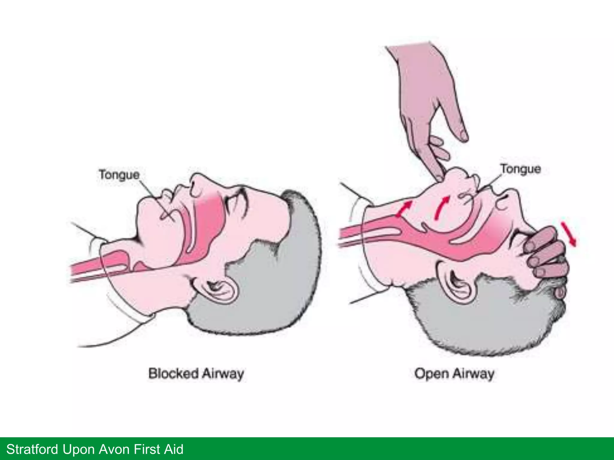 Cardiopulmonary resuscitation (cpr) | PPTX