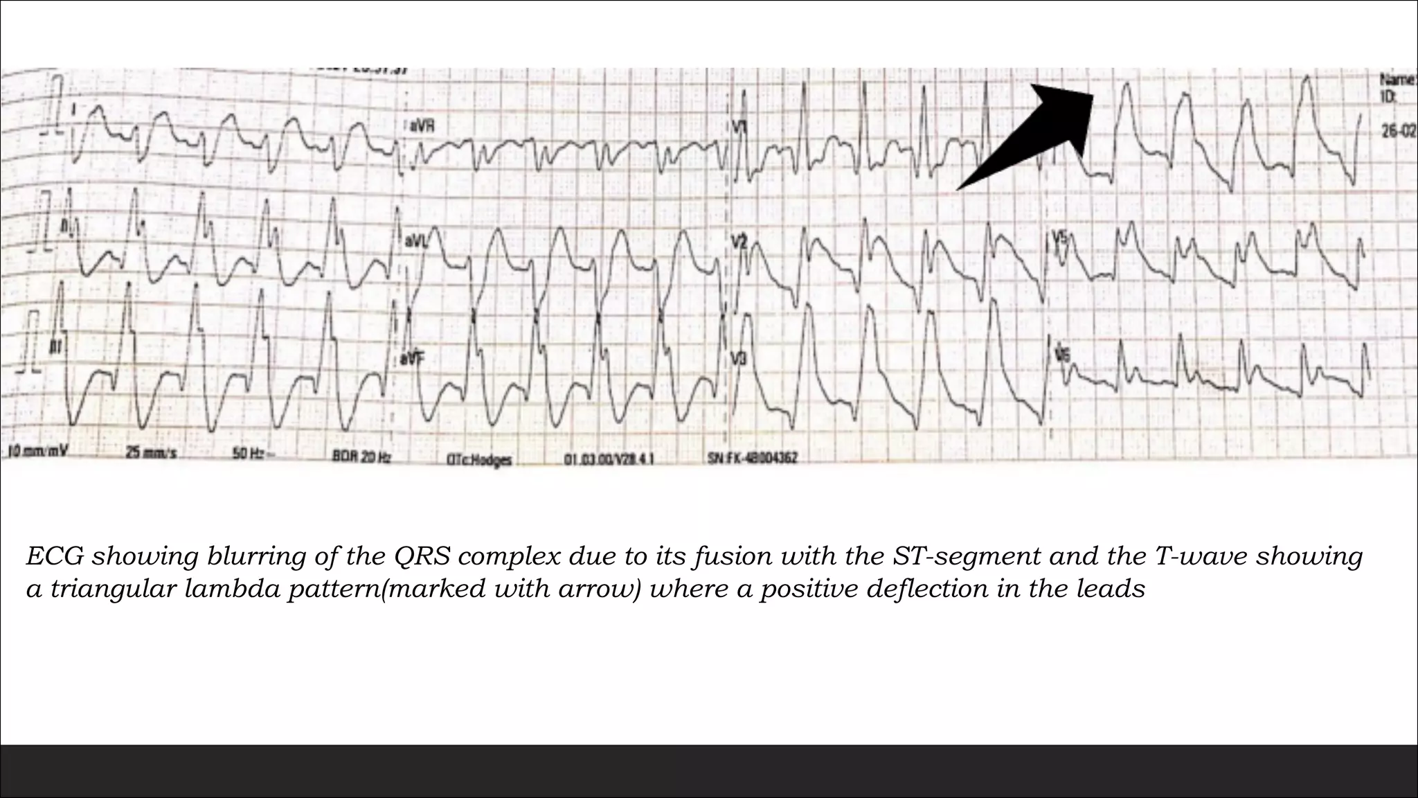 STEMI EQUIVALENT.pdf