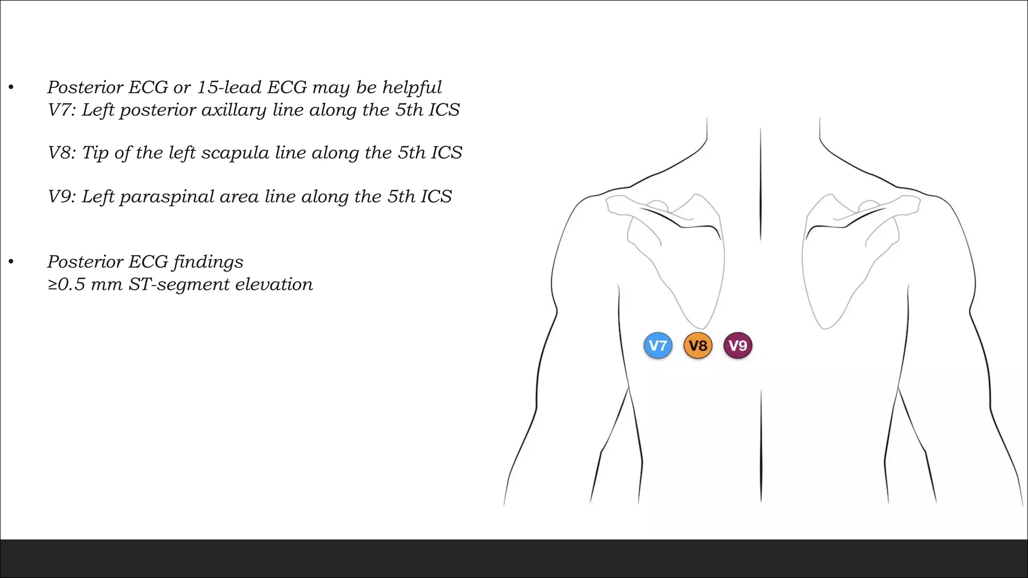 STEMI EQUIVALENT.pdf
