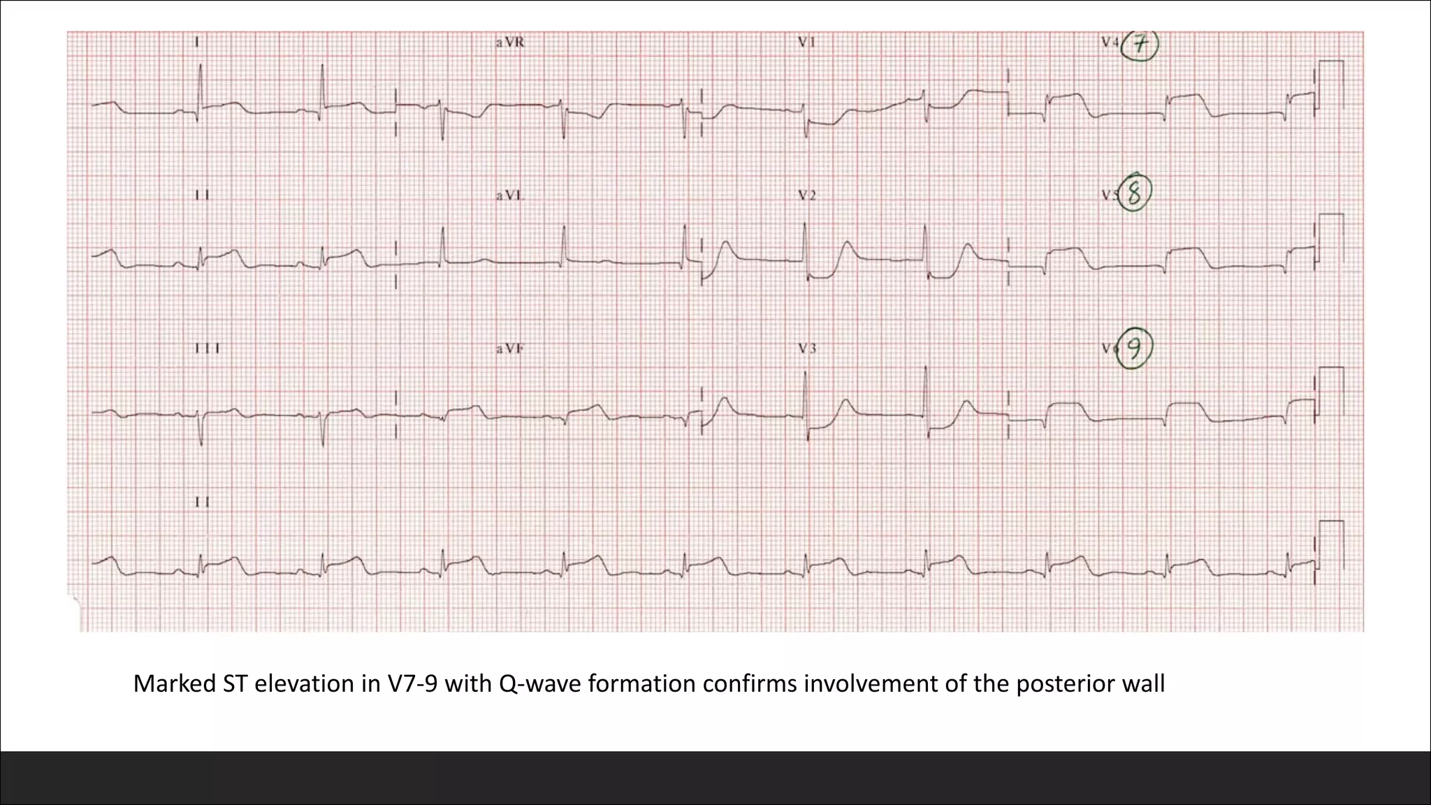 STEMI EQUIVALENT.pdf