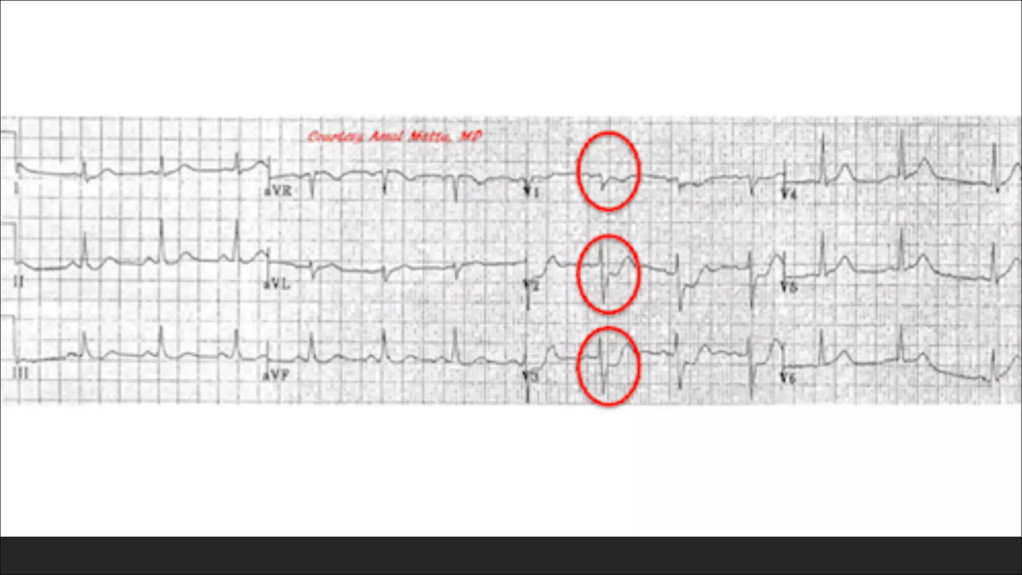 STEMI EQUIVALENT.pdf