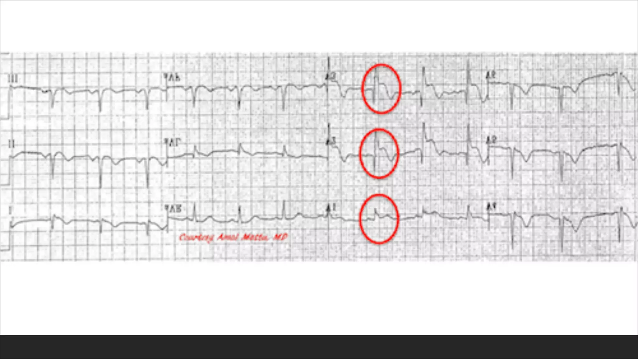 STEMI EQUIVALENT.pdf