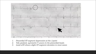 STEMI EQUIVALENT.pdf