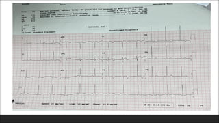 STEMI EQUIVALENT.pdf