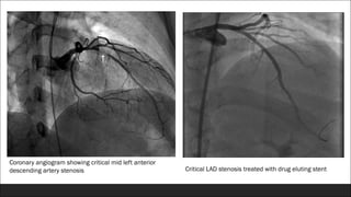 STEMI EQUIVALENT.pdf