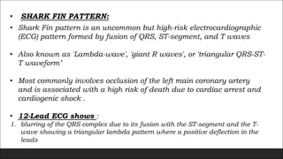 STEMI EQUIVALENT.pdf