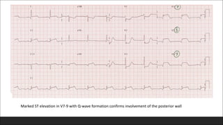 STEMI EQUIVALENT.pdf