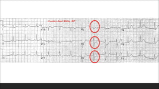 STEMI EQUIVALENT.pdf