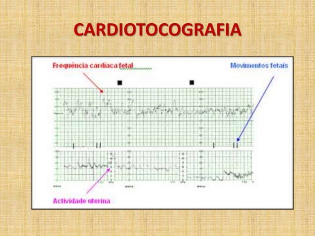 Cardiotocografia