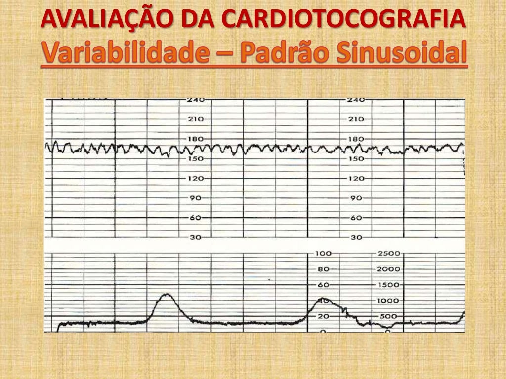 Cardiotocografia