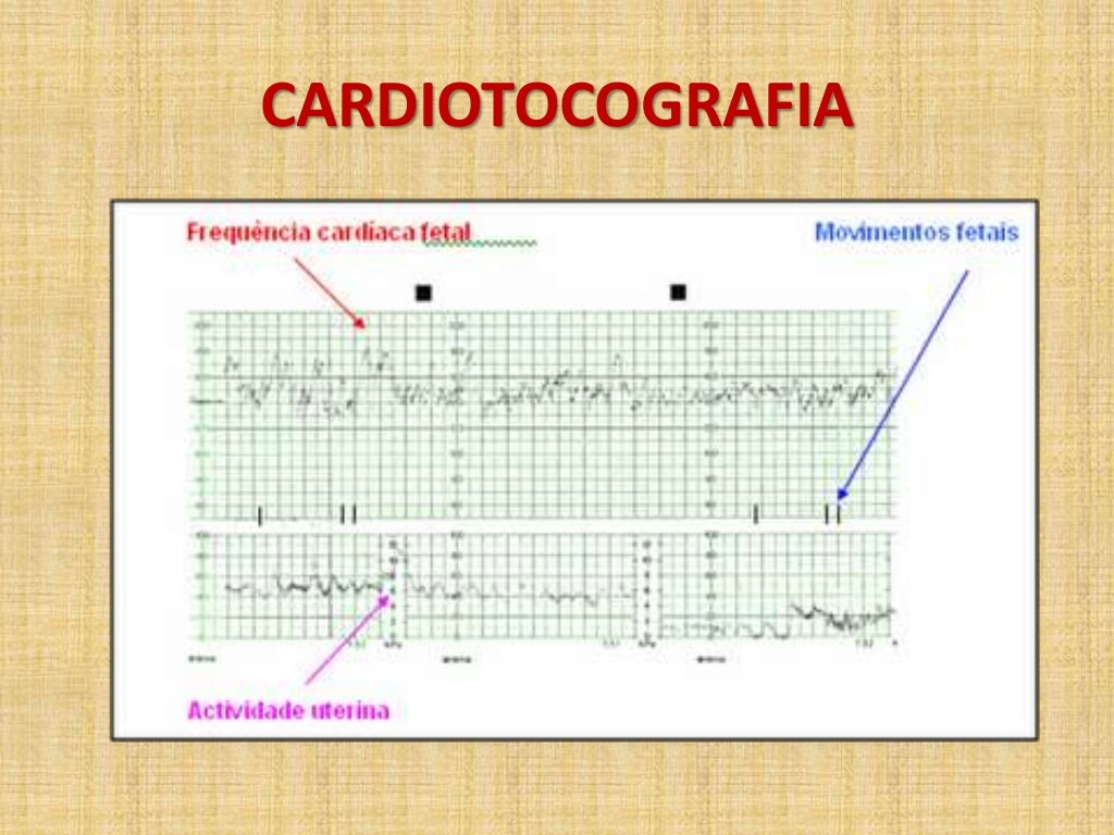 Cardiotocografia