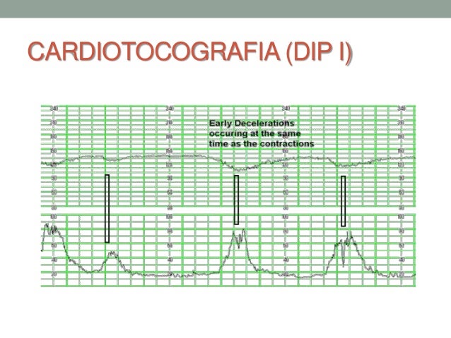 Cardiotocografia