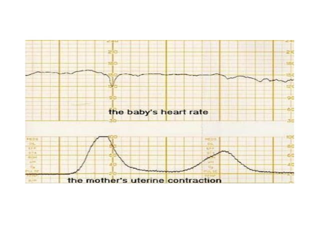 Cardiotocography | PDF