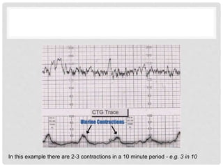 Cardiotocography | PPTX