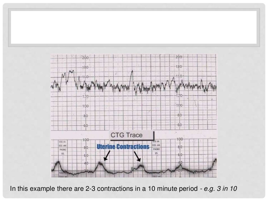 Cardiotocography