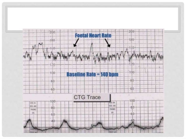 Cardiotocography