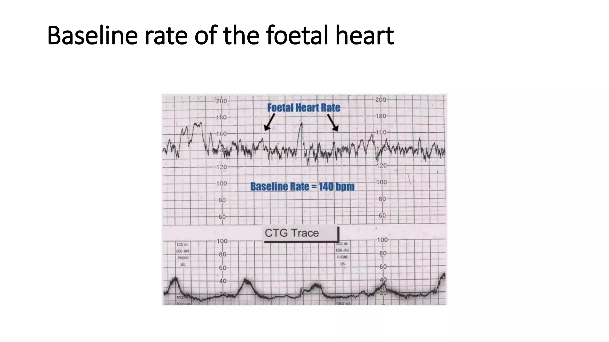 Cardiotocography | PPTX | Pregnancy | Reproductive Health