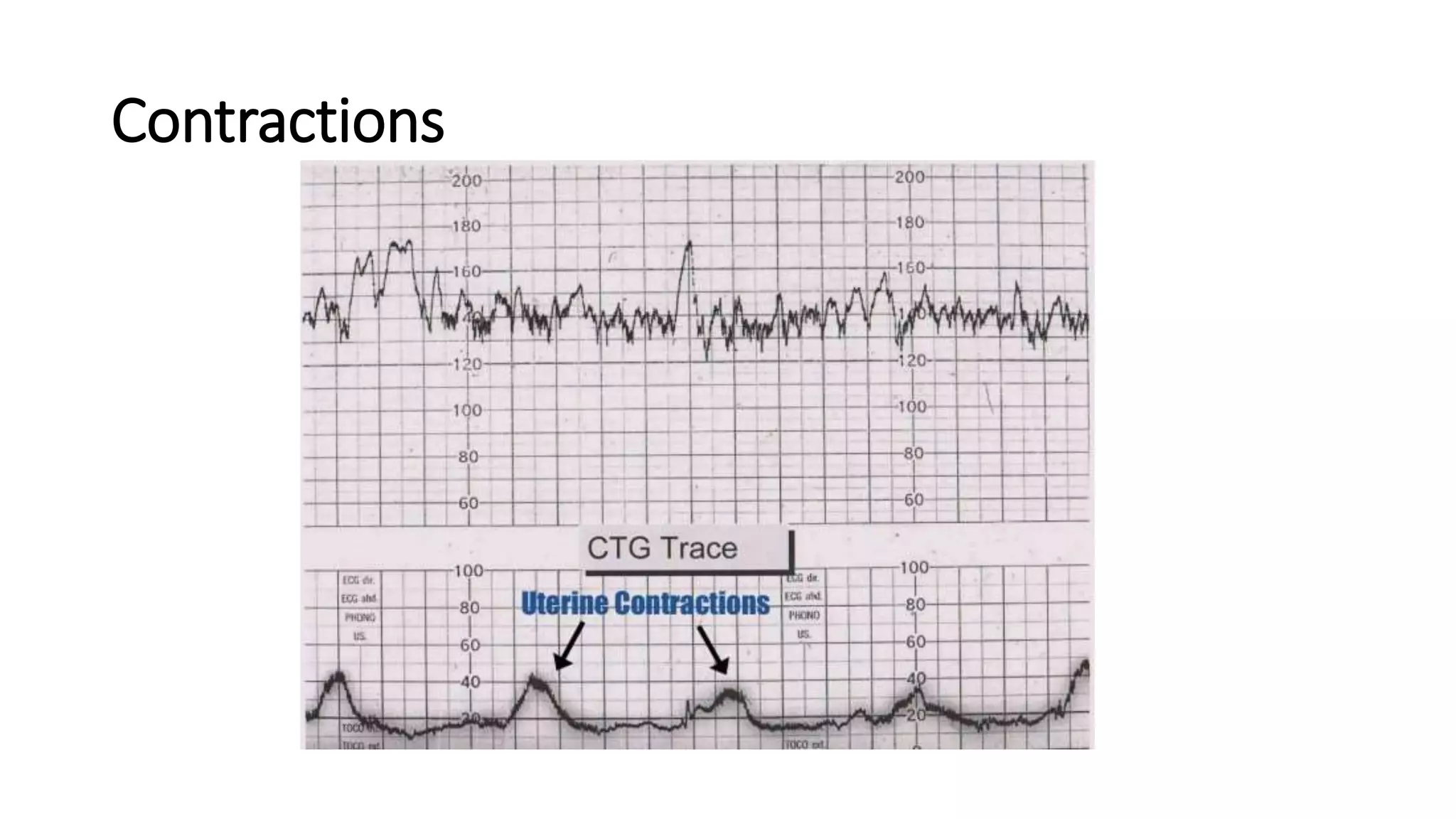 Cardiotocography | PPTX