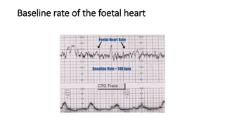 Cardiotocography | PPTX