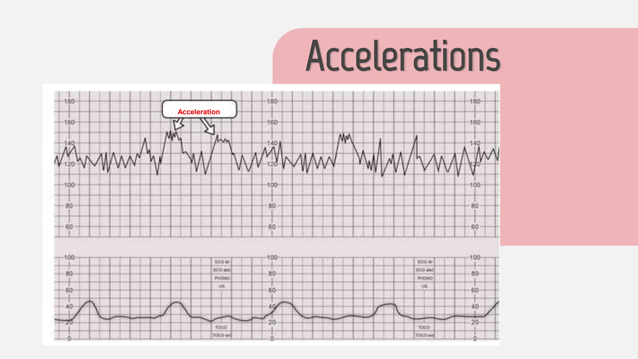 Cardiotocography A FETAL HR MONITORING METHOD | PPTX
