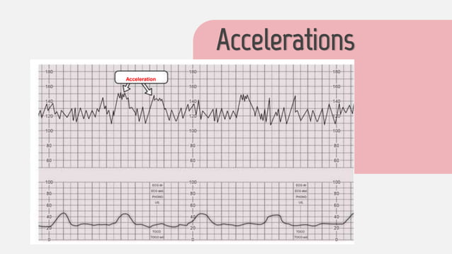 Cardiotocography A FETAL HR MONITORING METHOD | PPT