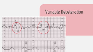 Cardiotocography A FETAL HR MONITORING METHOD | PPTX