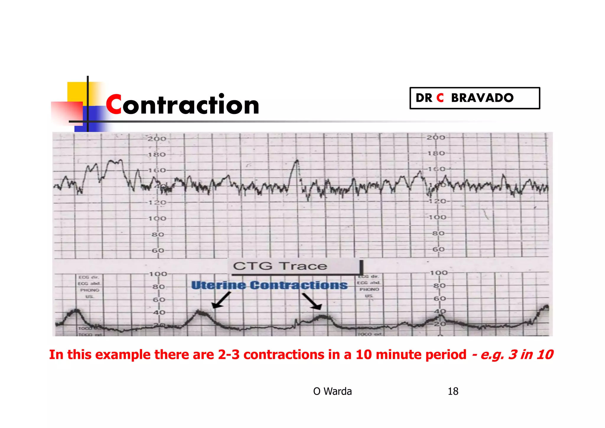 Cardiotocography (CTG) warda | PDF