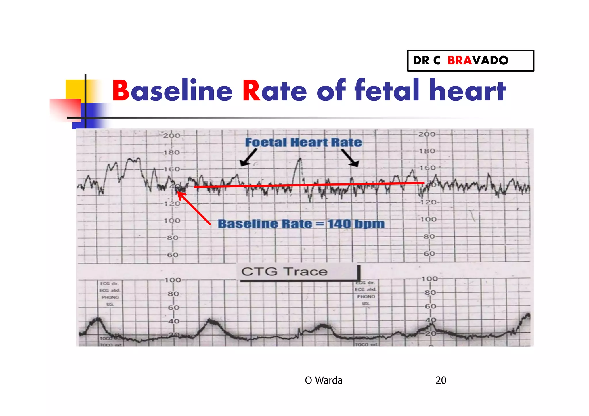 Cardiotocography (CTG) warda | PDF