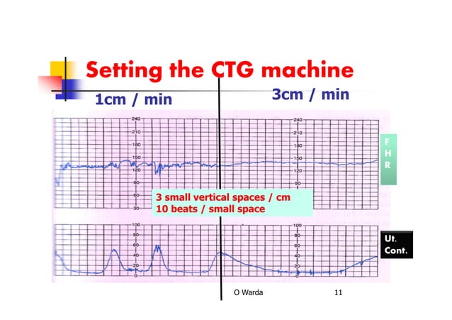Cardiotocography (CTG) warda | PPT
