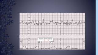 Cardiotocography | PPTX