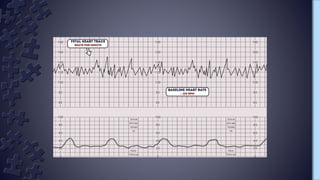 Cardiotocography | PPTX