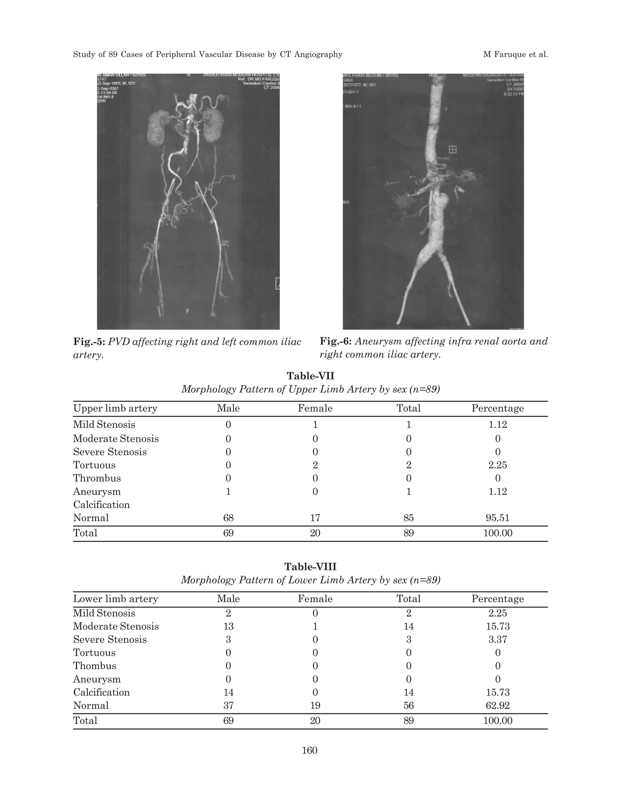 Study of 89 Cases of Peripheral Vascular Disease by CT Angiography | PDF