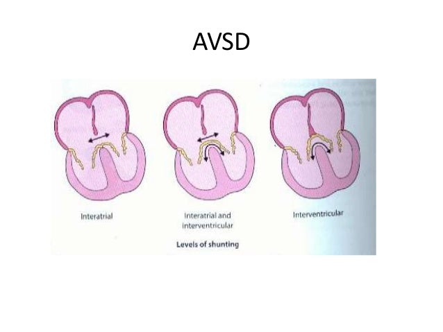 Cardiovascular Embryology and Congenital abnormalities
