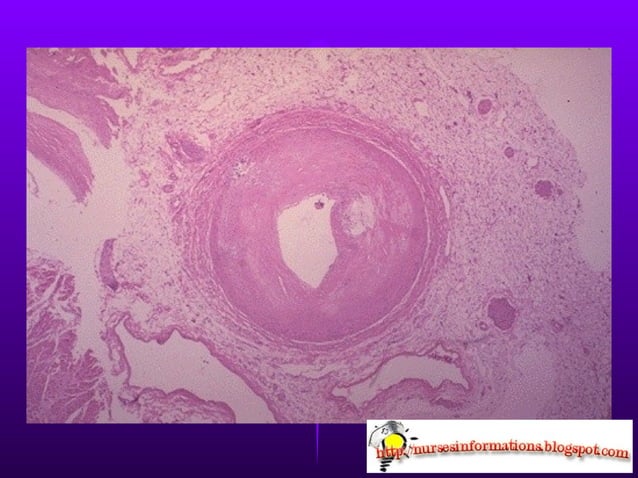 Cardiovascular Pathology (part 1) | PPT | Heart and Cardiovascular ...