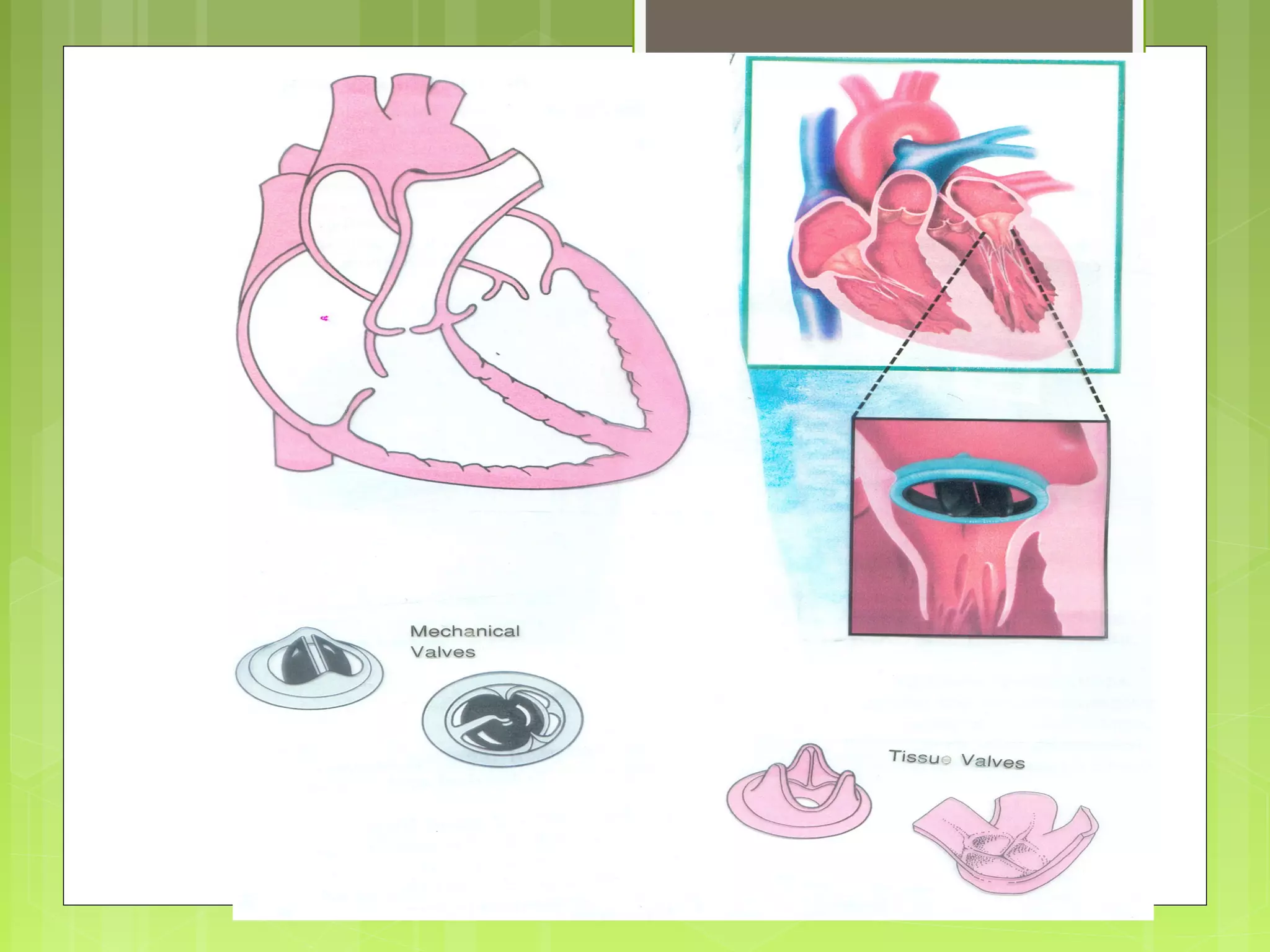Cardiovascular disease, interventions and care | PPT