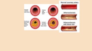Cardiovascular disease adalah penyakit pada jantung dan pembuluh darah ...