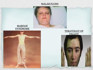 Malar Flush Mitral Stenosis