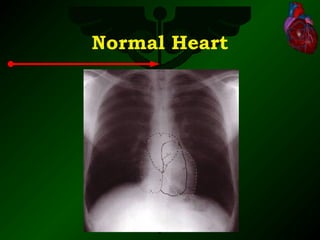 Cardiovascular Radiology Acquired Disease.ppt