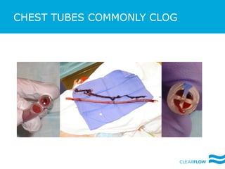 Cardiovascular Surgery Complications | PDF