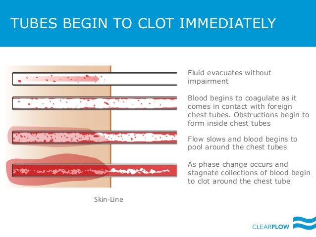 Cardiovascular Surgery Complications