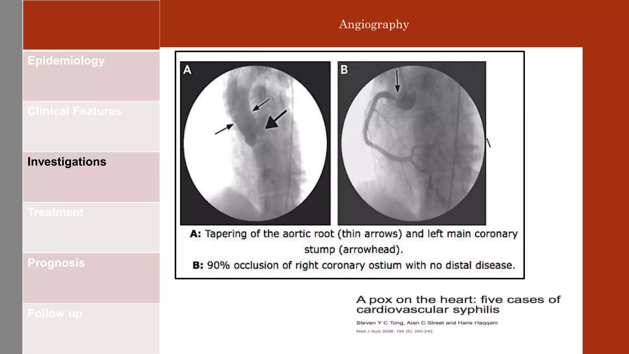 Cardiovascular syphilis | PPTX