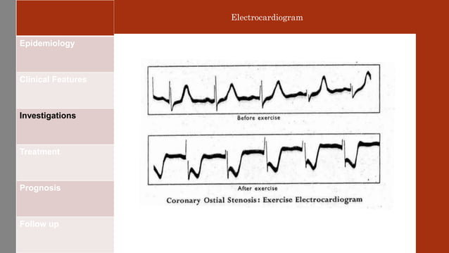 Cardiovascular syphilis | PPTX | Infectious Diseases | Diseases and ...
