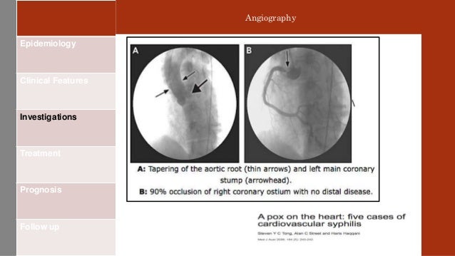 Cardiovascular syphilis