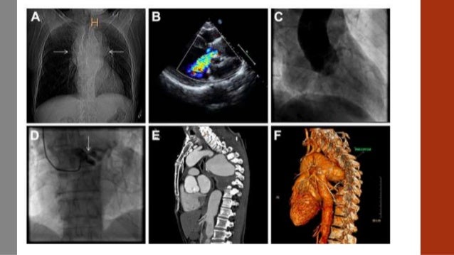 Cardiovascular syphilis