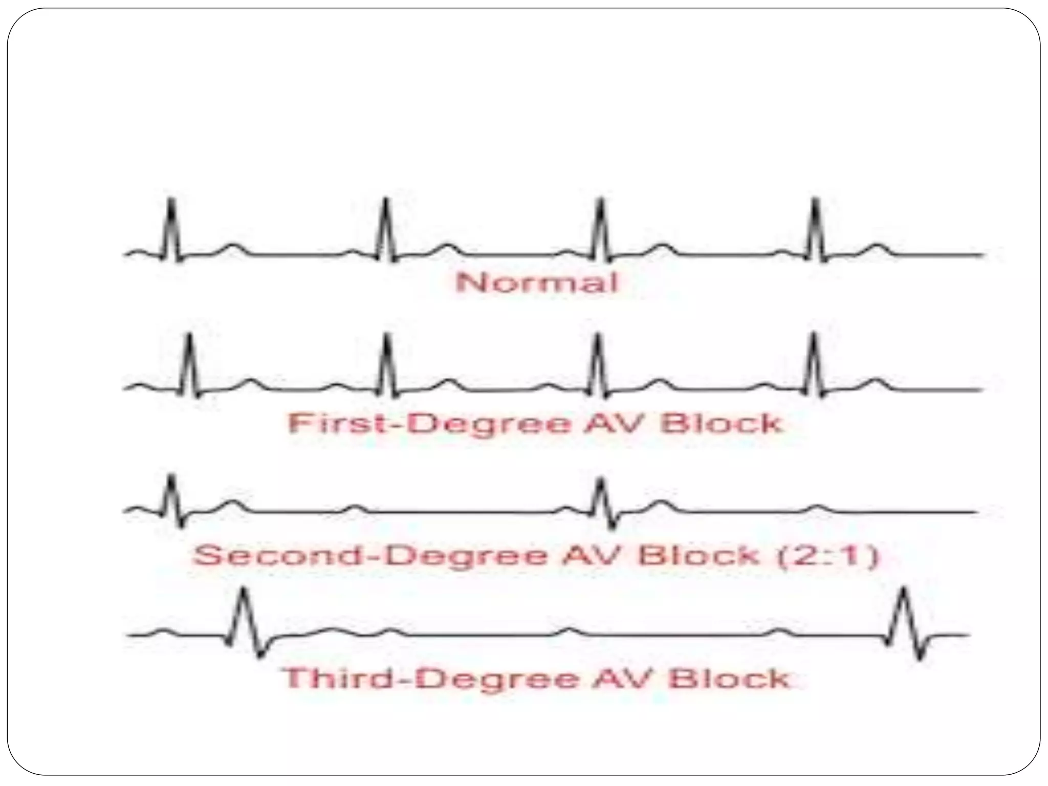 Cardiovascular system arrhythmia Disorders of heart Rate and rhythm and ...
